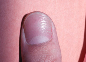 What Do Yellow Fingernails (With or Without Lifting + Pitting) Mean ...